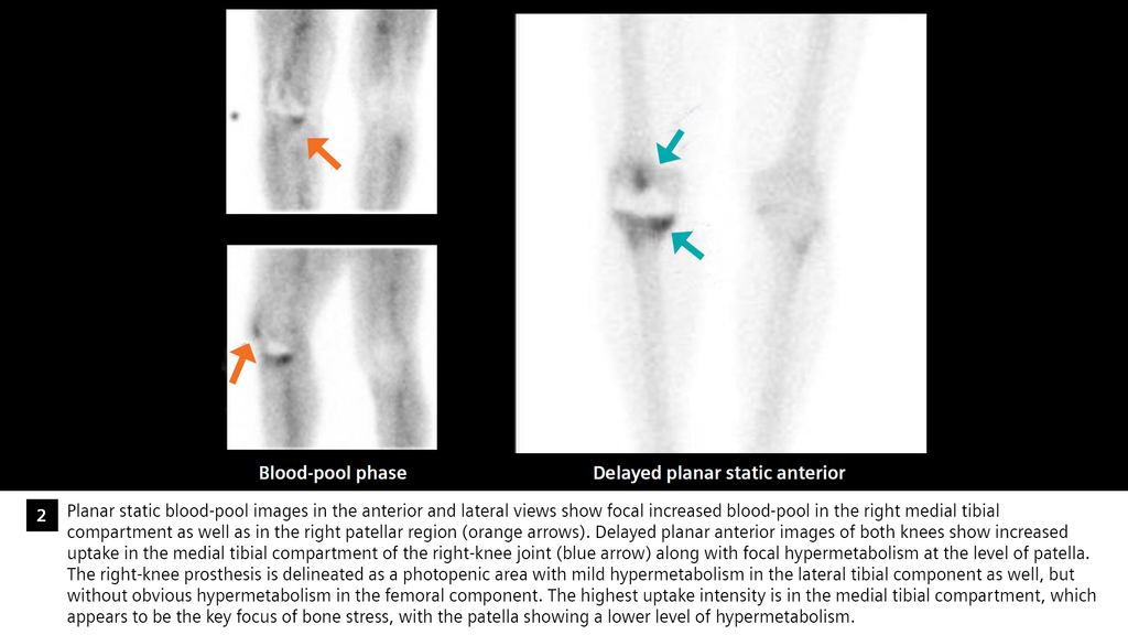 Loosening of tibial component of knee arthroplasty with medial ...