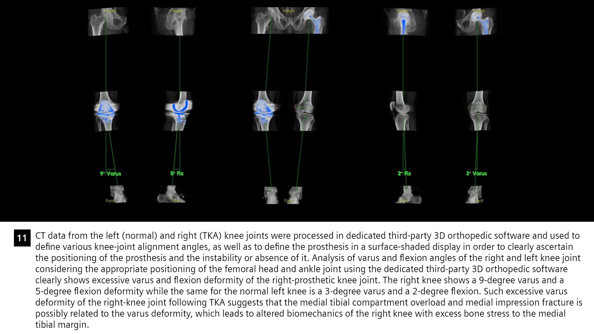 Loosening of tibial component of knee arthroplasty with medial ...