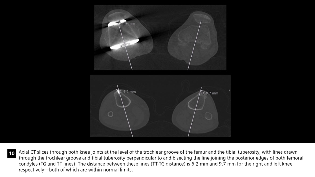 Loosening of tibial component of knee arthroplasty with medial ...