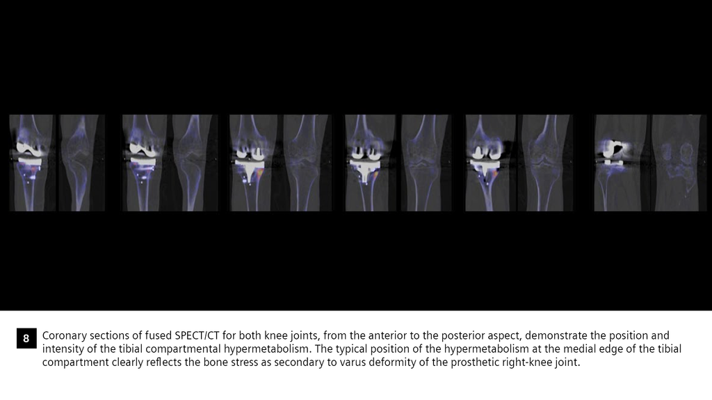 Loosening of tibial component of knee arthroplasty with medial ...
