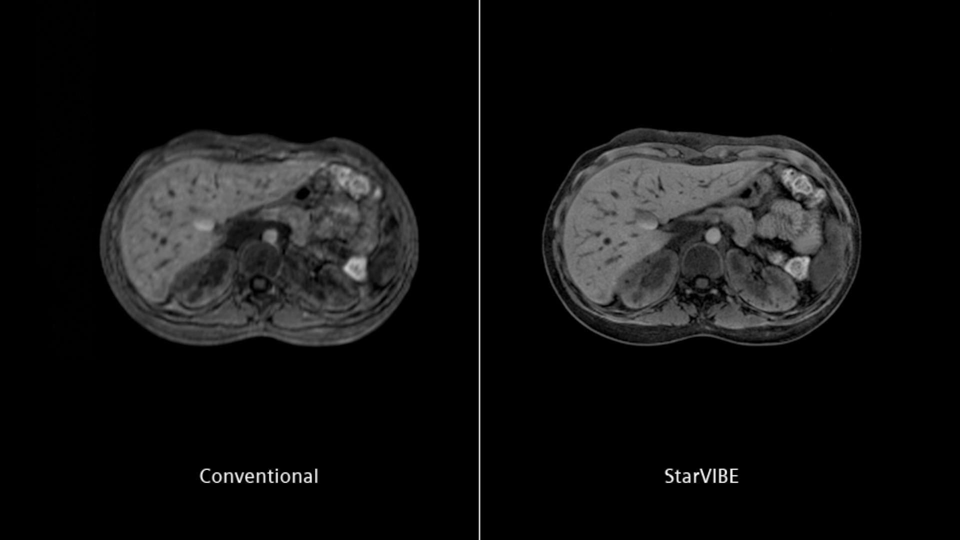 Many liver MRI examinations are hardly clinical due to motion artifacts ...