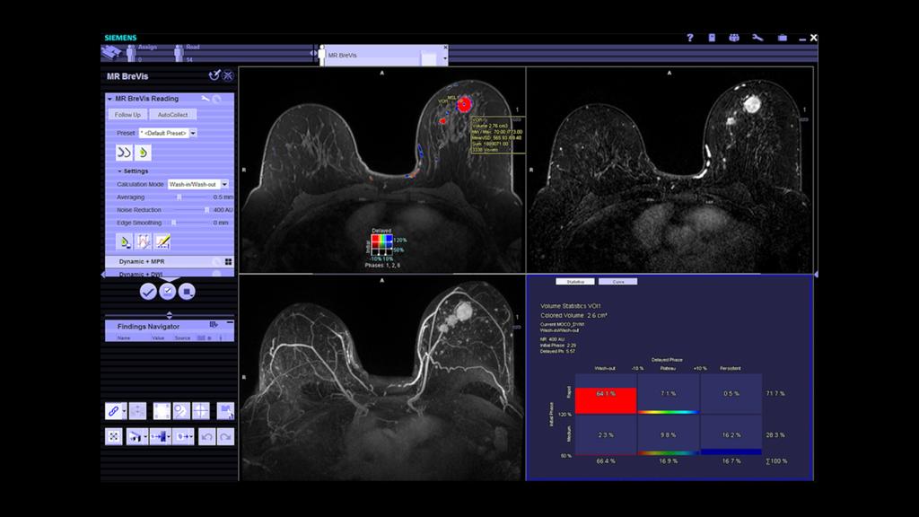 Breast MRI - Siemens Healthineers