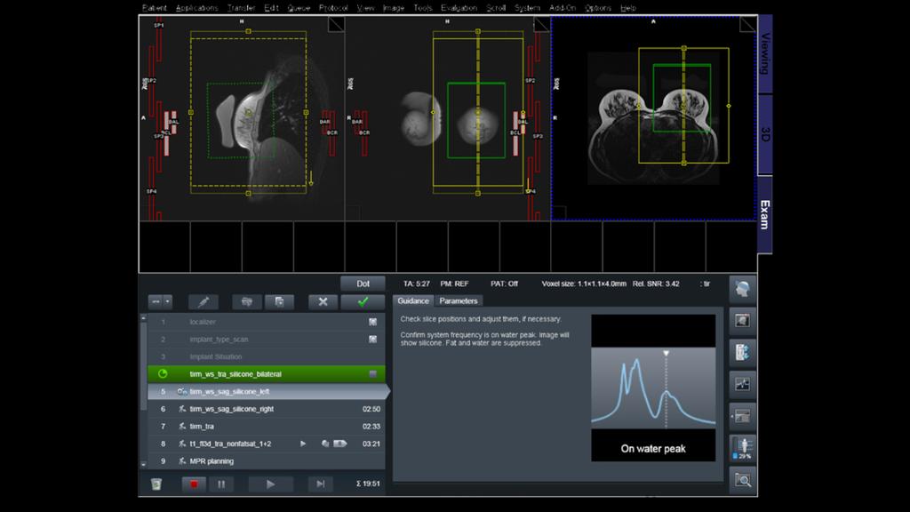 Breast MRI