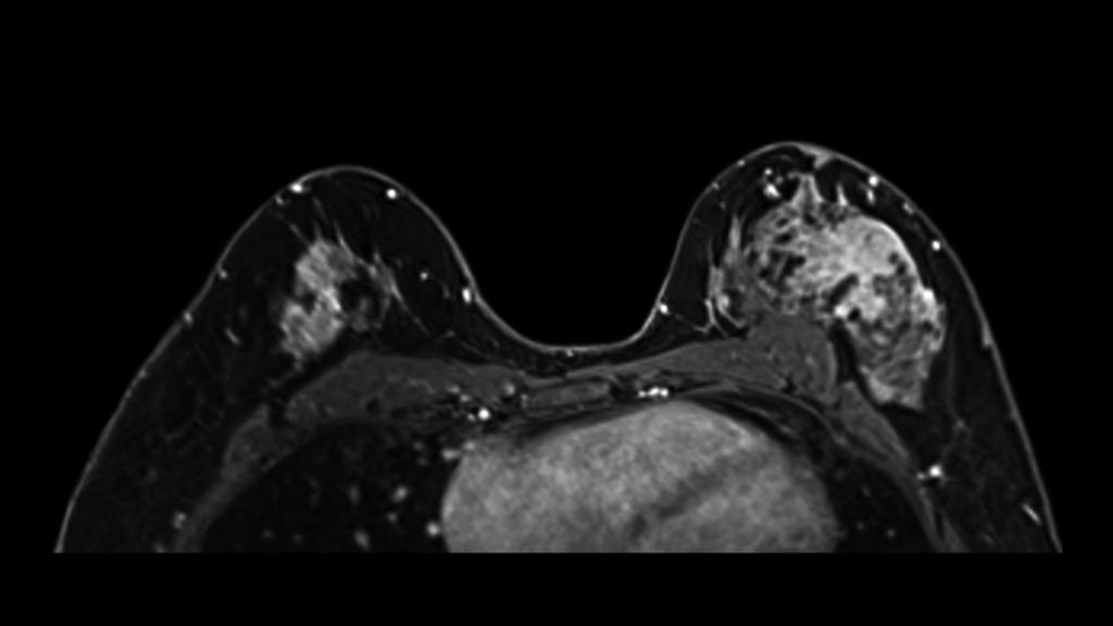 Breast MRI - Siemens Healthineers