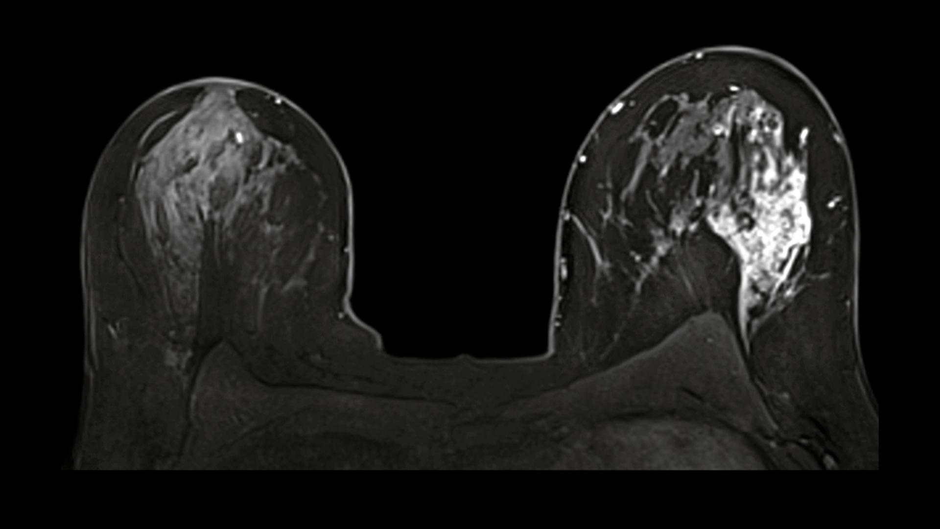 Breast MRI - Siemens Healthineers