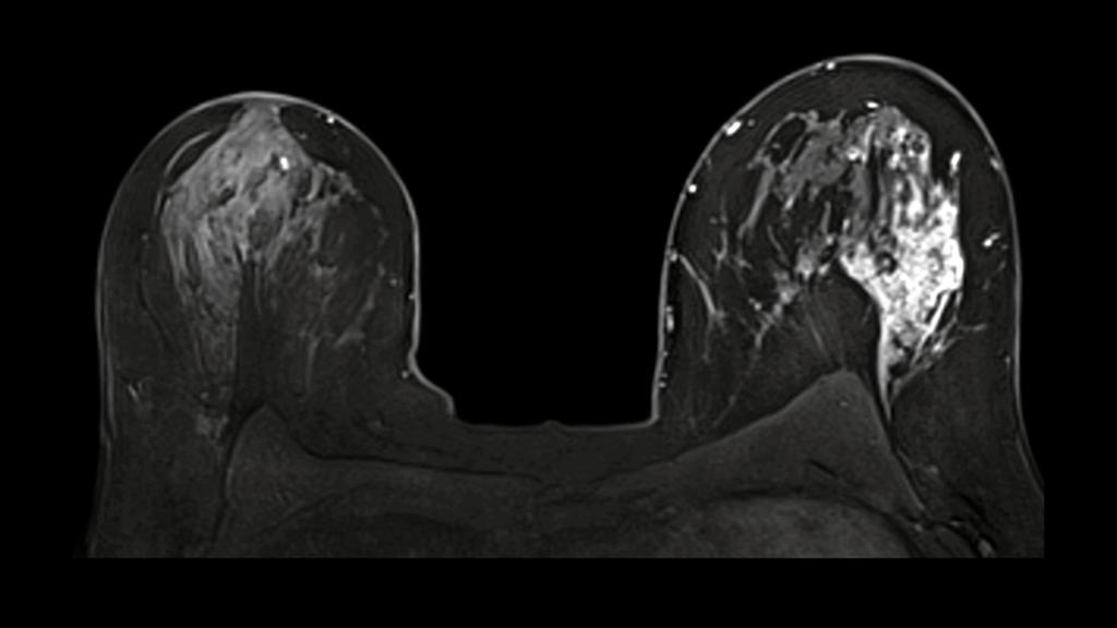 Breast MRI - Siemens Healthineers USA