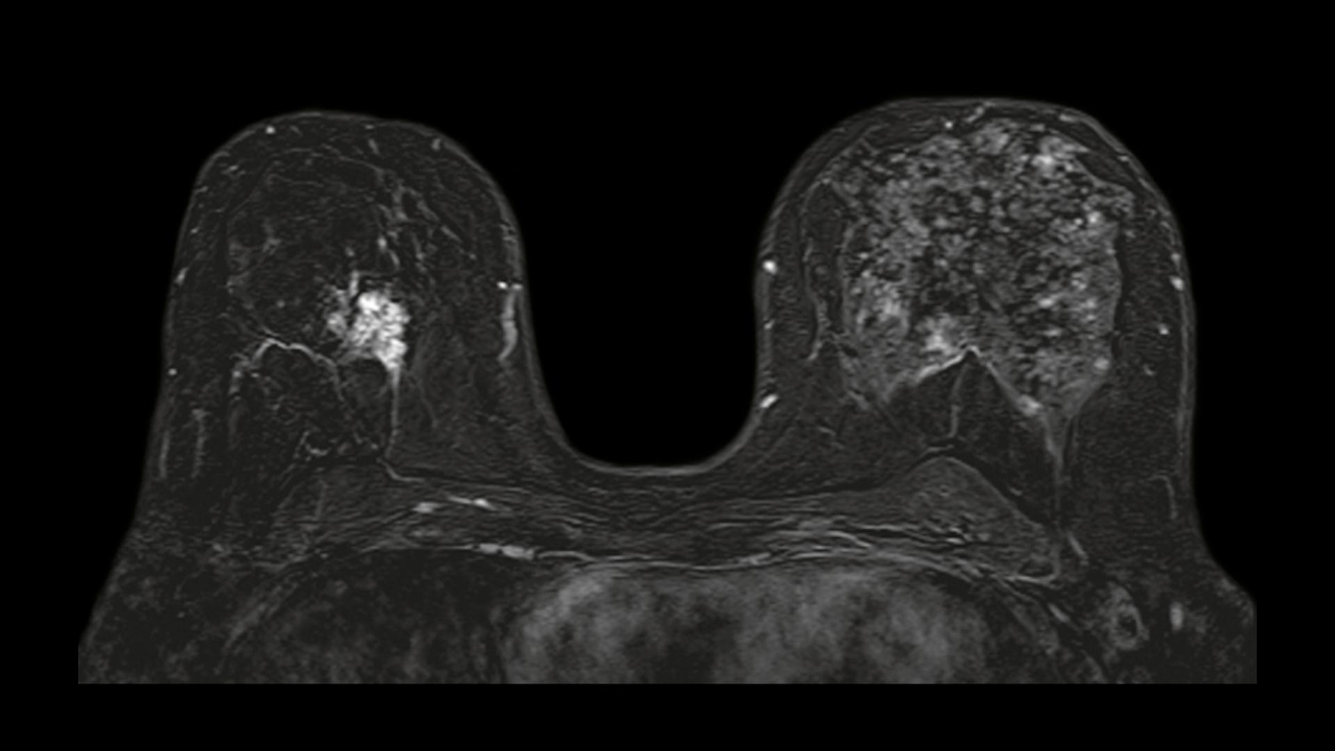 Breast MRI - Siemens Healthineers