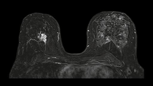 Breast MRI - Siemens Healthineers USA