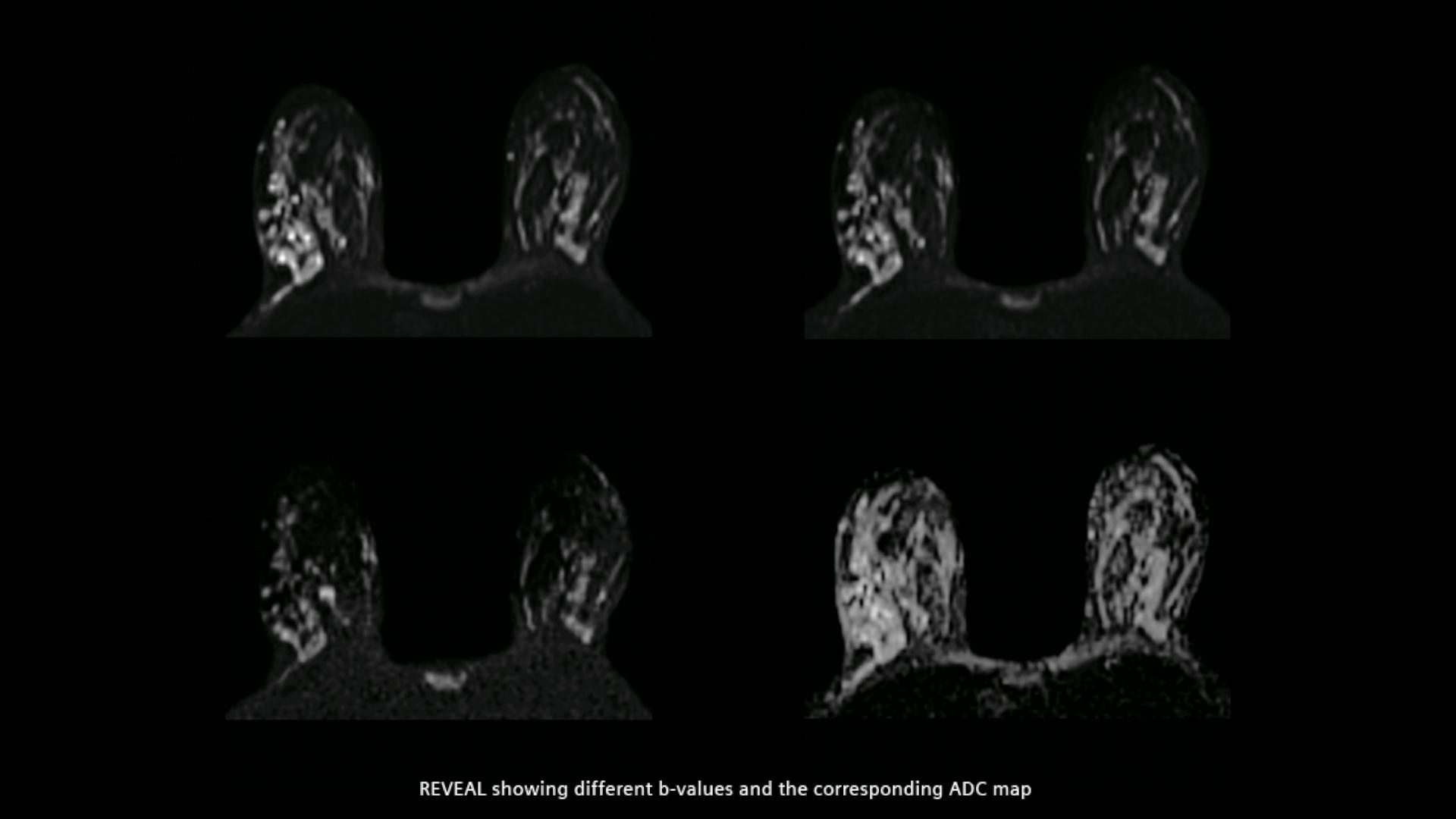Breast MRI - Siemens Healthineers