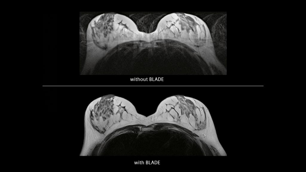 Breast MRI - Siemens Healthineers