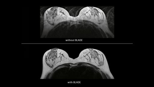 Breast MRI - Siemens Healthineers