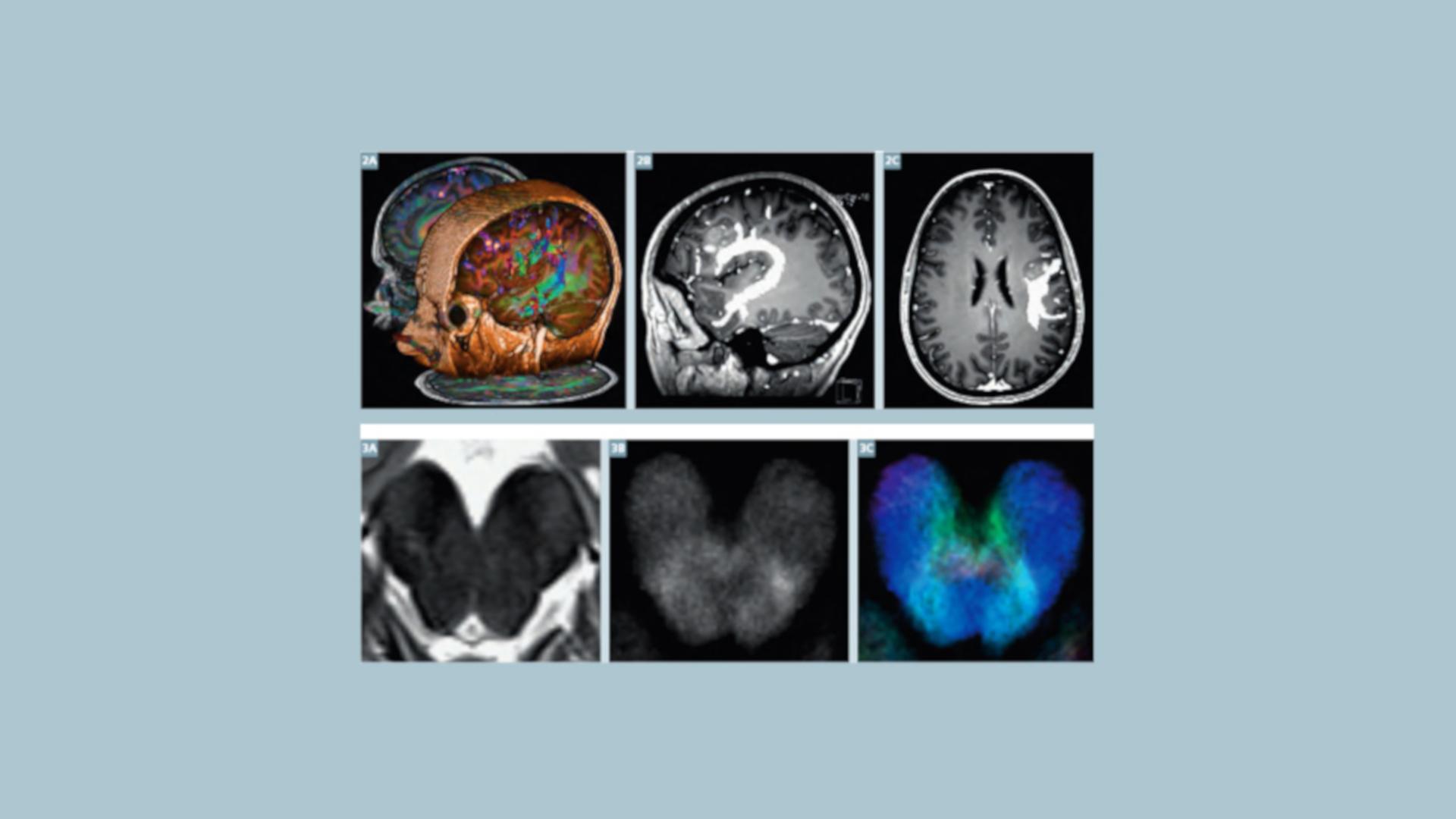 MR Neuro Imaging - MRI Neurology - Siemens Healthineers