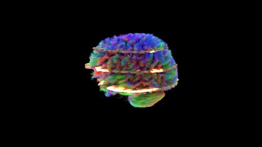 MR Neuro Imaging - MRI Neurology - Siemens Healthineers