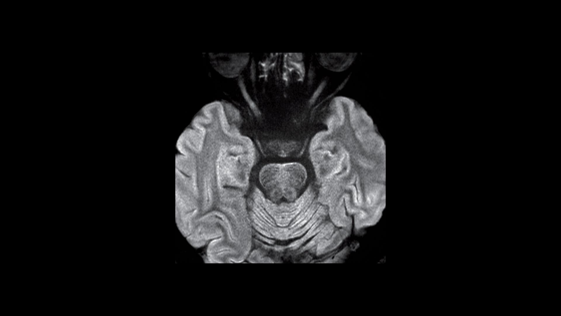 MR Neuro Imaging - MRI Neurology - Siemens Healthineers