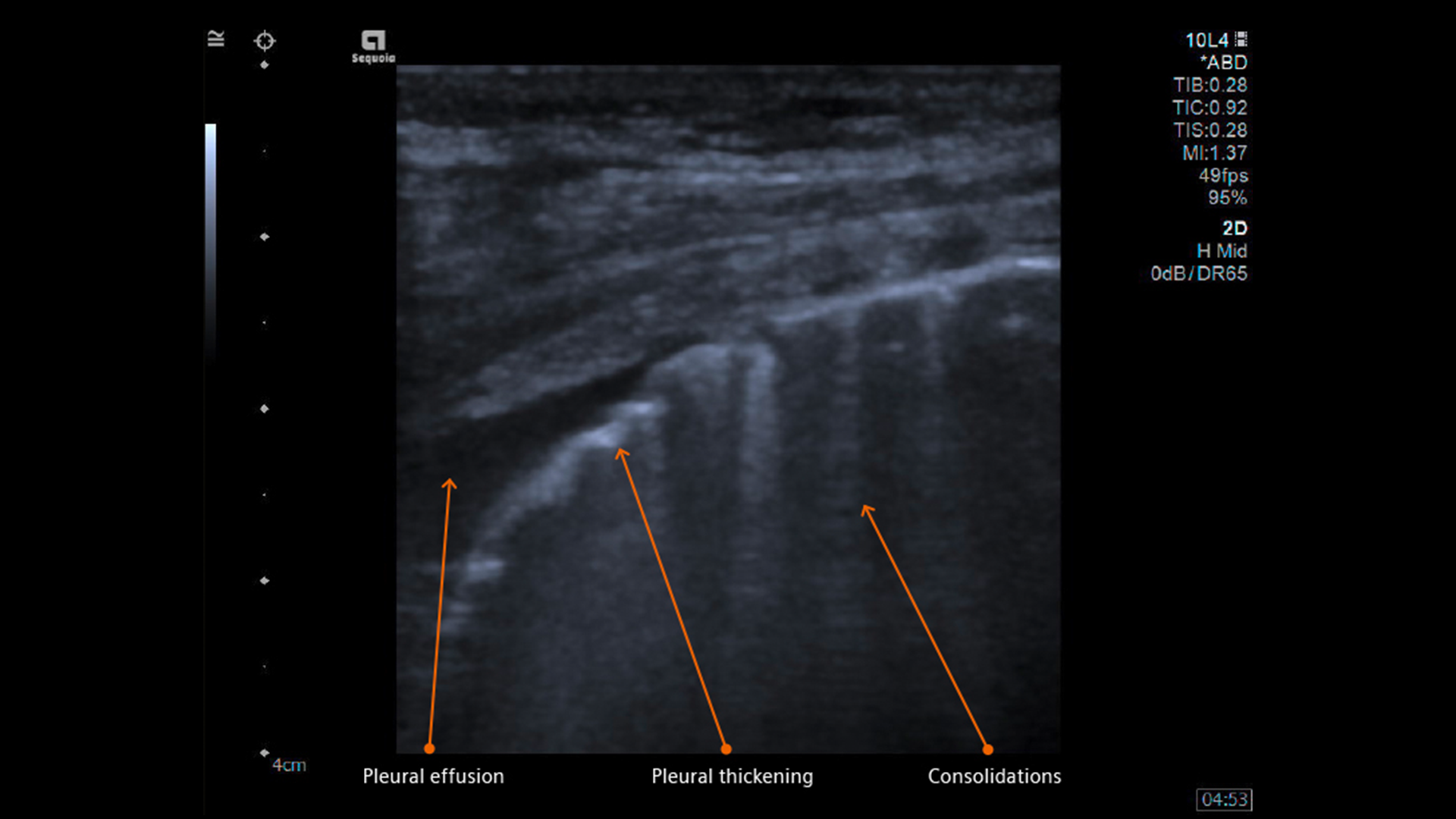 White Paper: Lung Ultrasound in Patients with Coronavirus COVID-19 Disease