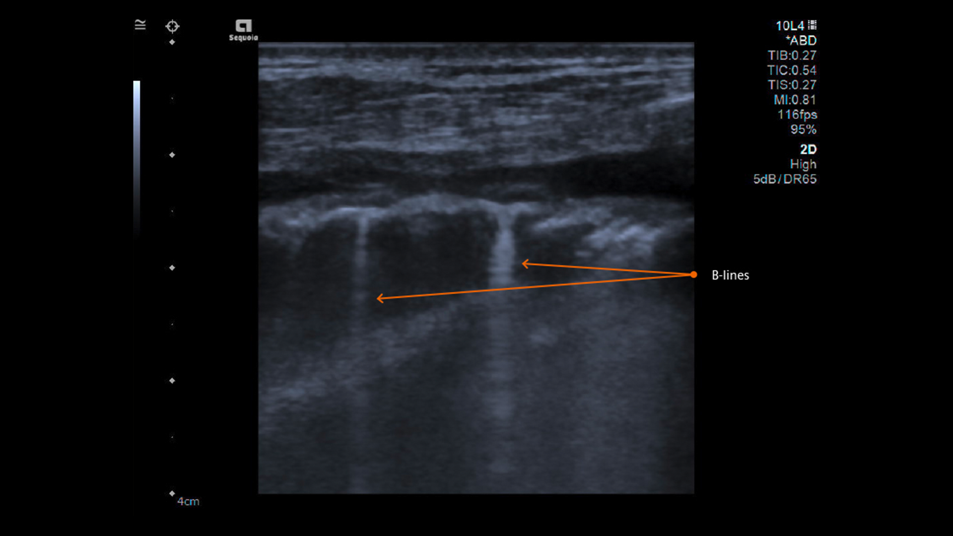White Paper: Lung Ultrasound in Patients with Coronavirus COVID-19 ...