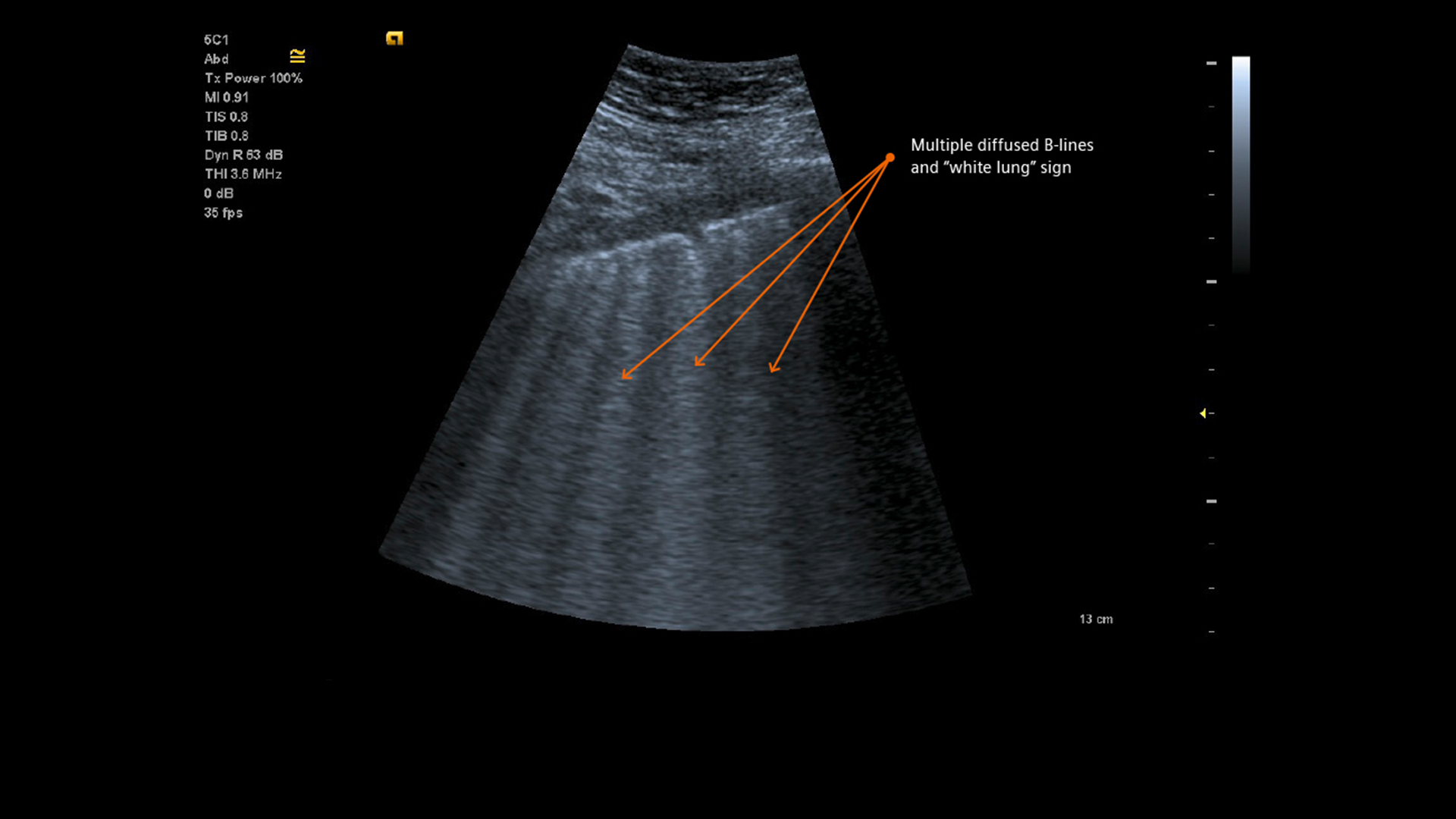 White Paper: Lung Ultrasound in Patients with Coronavirus COVID-19 Disease