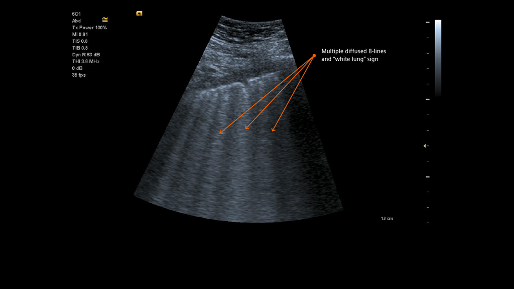 White Paper: Lung Ultrasound in Patients with Coronavirus COVID-19 ...