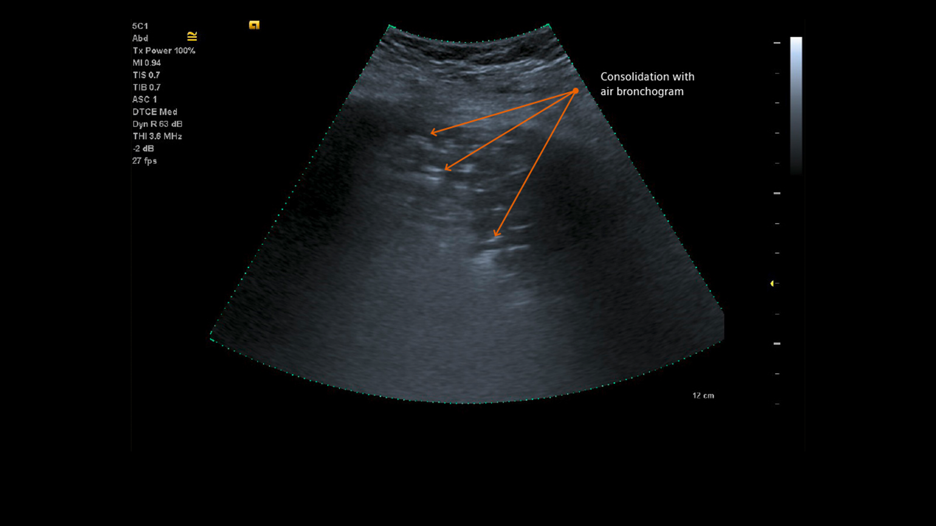White Paper: Lung Ultrasound in Patients with Coronavirus COVID-19 ...
