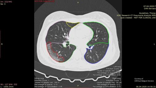 AI COVID-19 - Siemens Healthineers