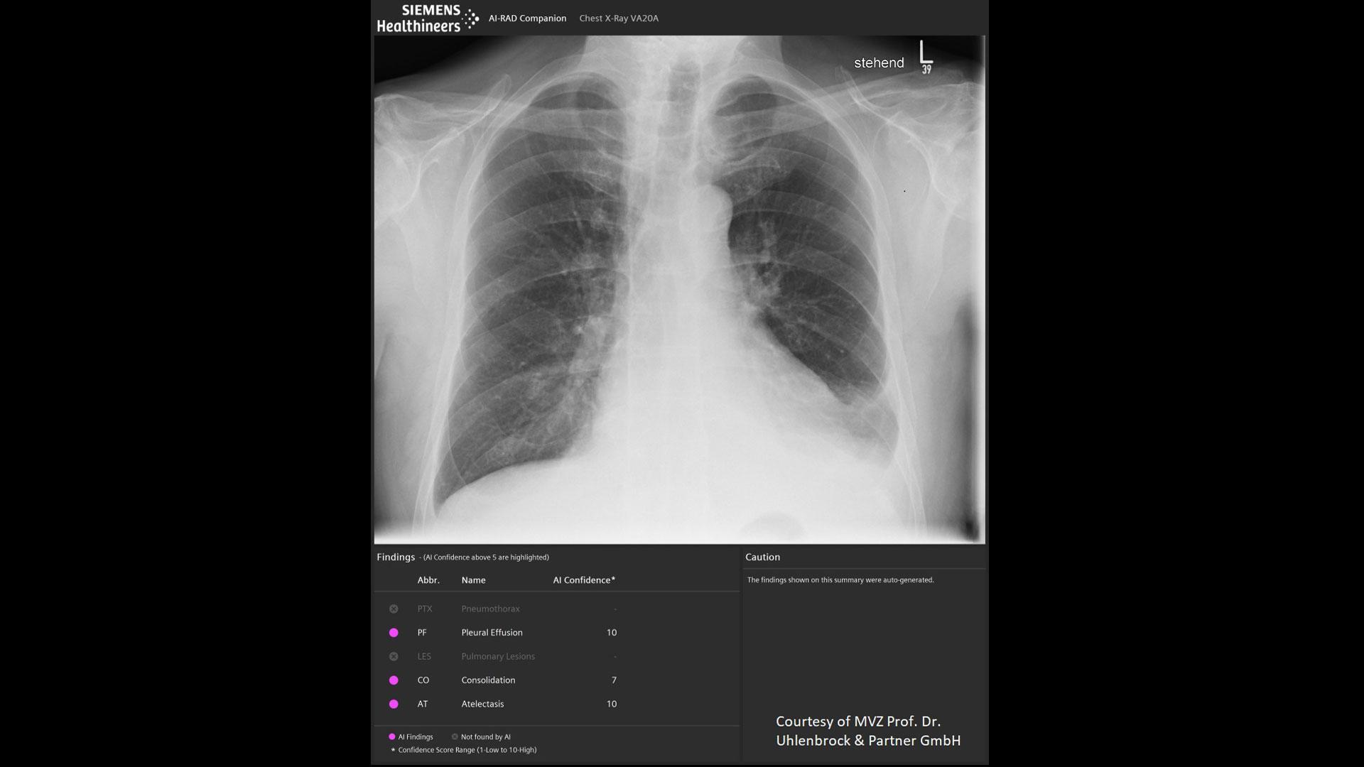 AI COVID-19 - Siemens Healthineers