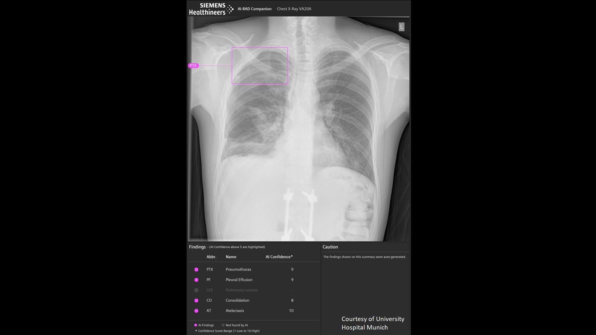 AI COVID-19 - Siemens Healthineers
