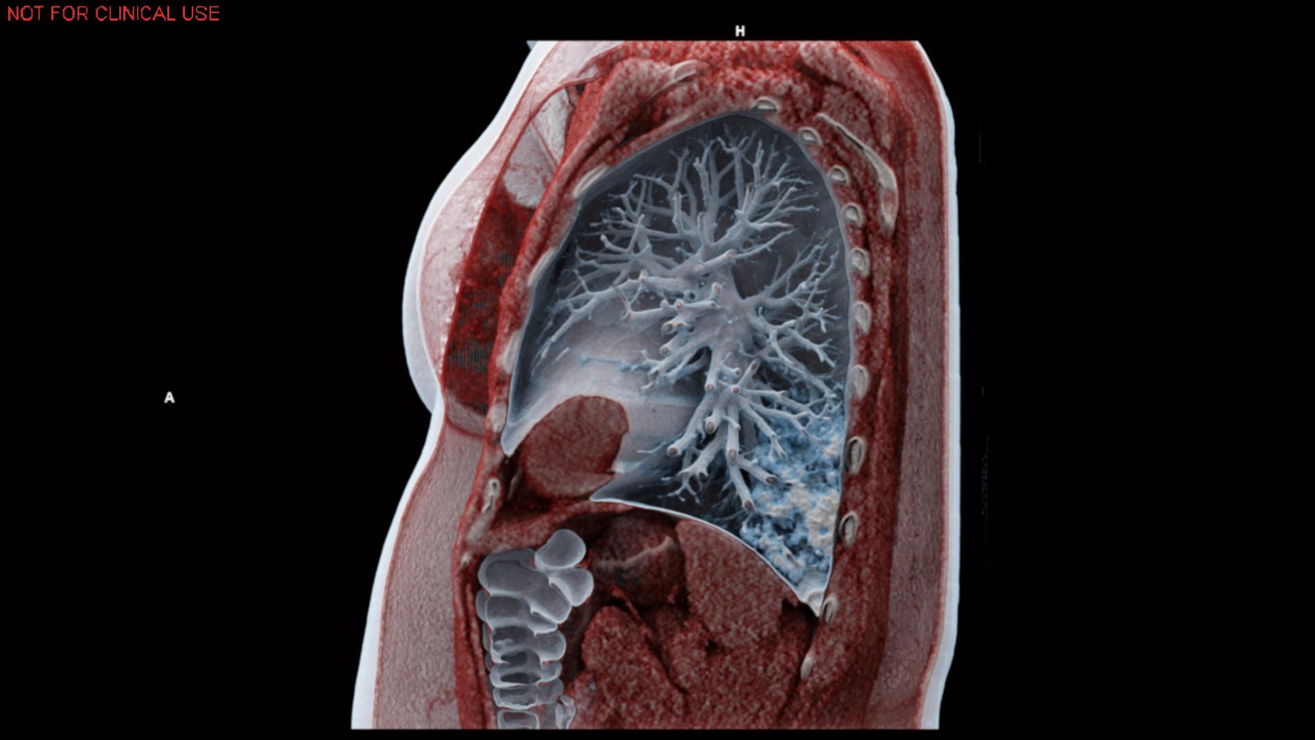 AI-Rad Companion - Siemens Healthineers Latinoamérica