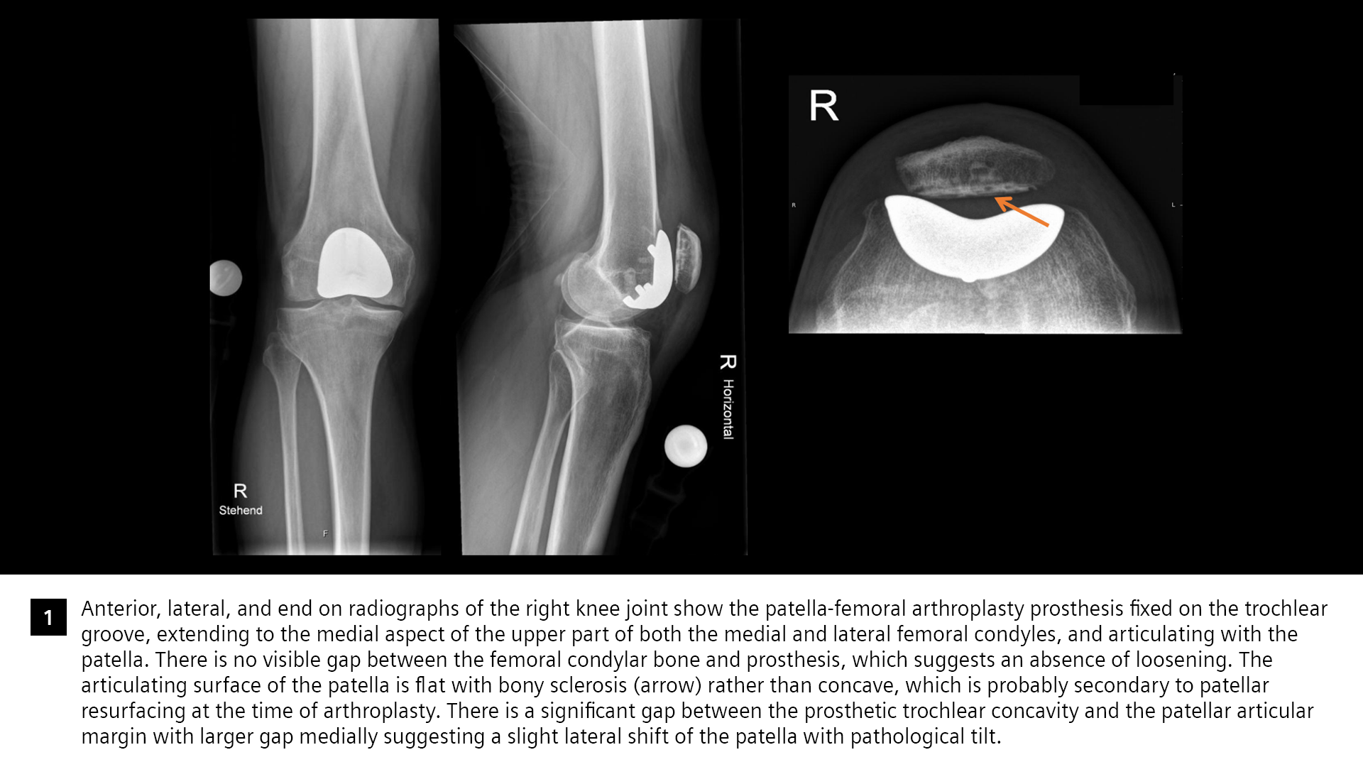 SPECT/CT in evaluation of anterior knee pain following patellofemoral ...