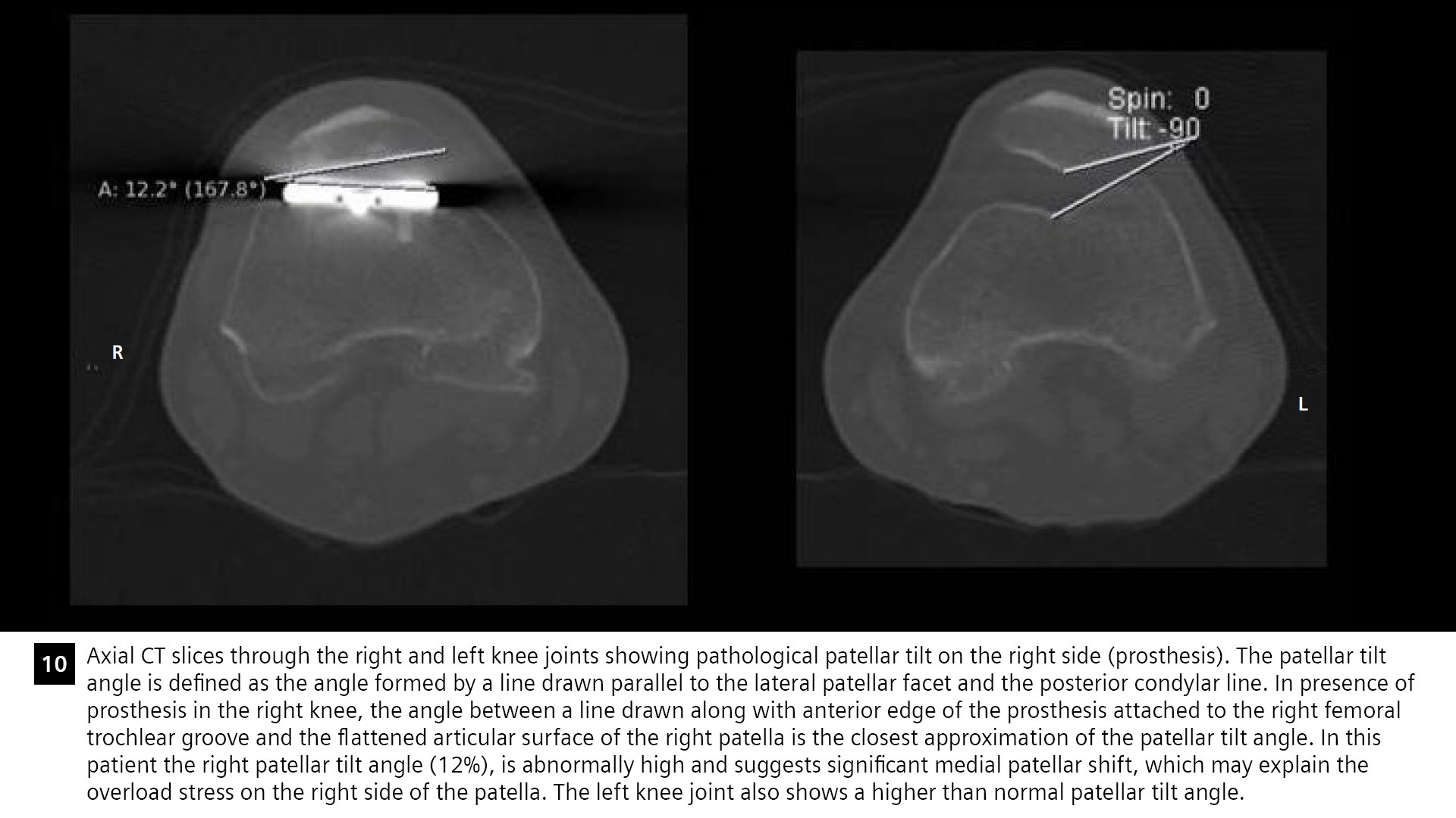 SPECT/CT in evaluation of anterior knee pain following patellofemoral ...