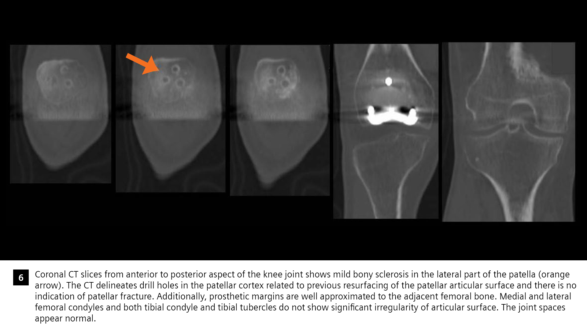 SPECT/CT in evaluation of anterior knee pain following patellofemoral ...