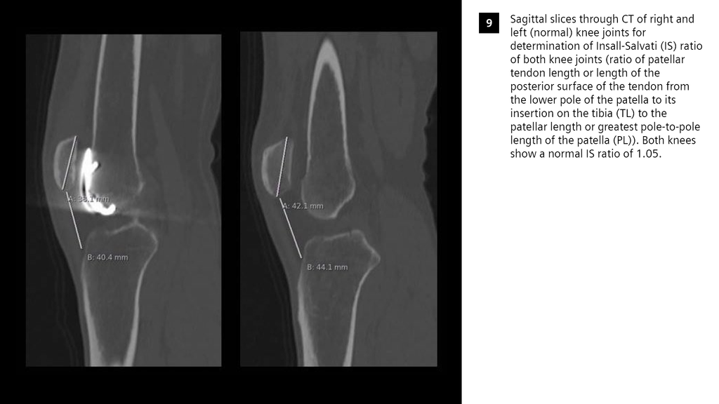 SPECT/CT in evaluation of anterior knee pain following patellofemoral ...