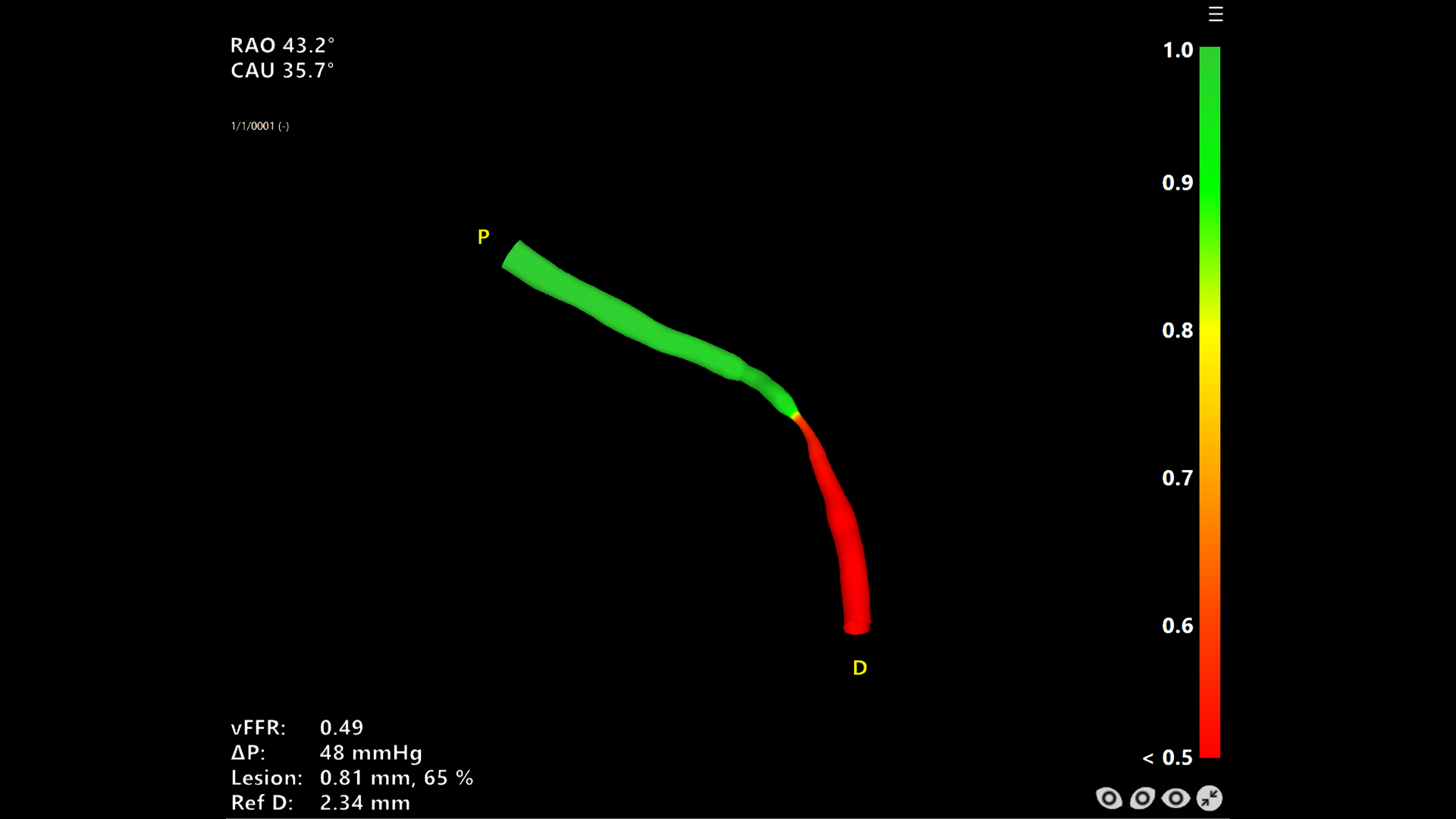 CAAS vFFR - angio-derived FFR measurement - Siemens Healthineers USA
