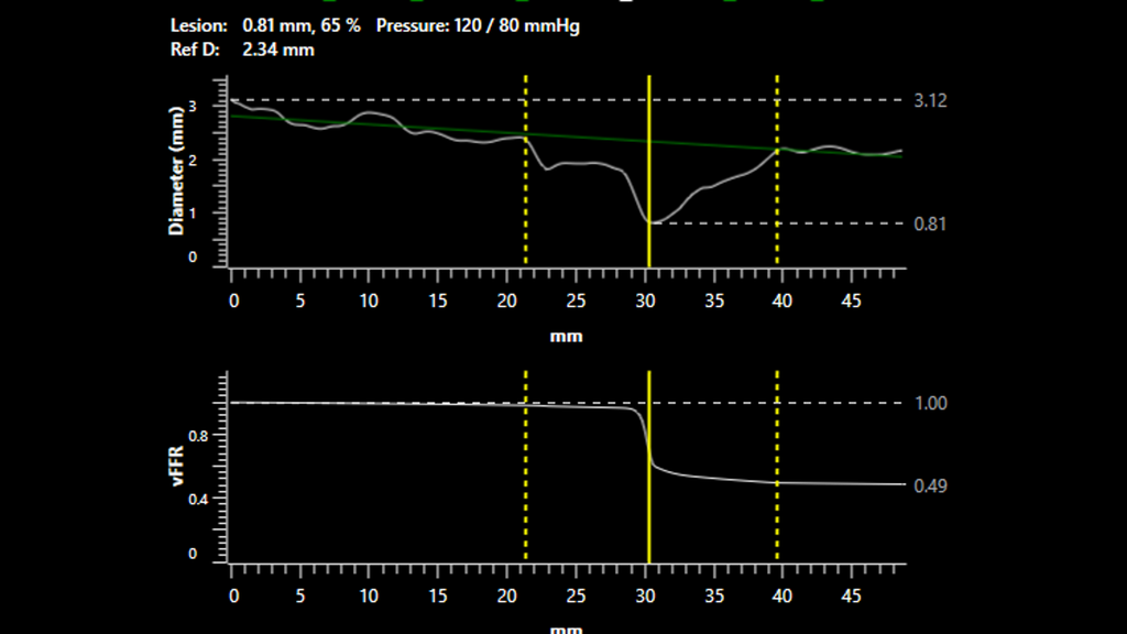 CAAS vFFR - angio-derived FFR measurement - Siemens Healthineers USA