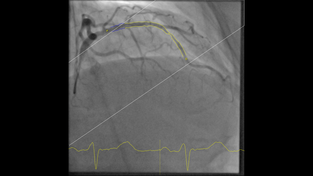 CAAS vFFR - angio-derived FFR measurement - Siemens Healthineers USA