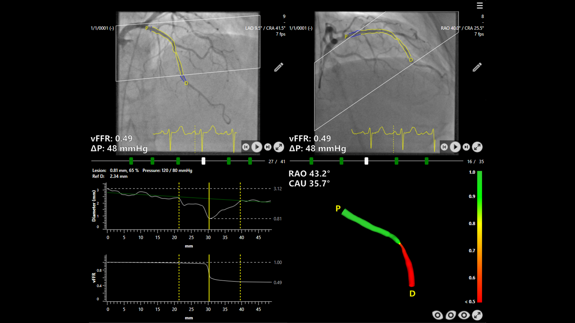 CAAS vFFR - angio-derived FFR measurement - Siemens Healthineers USA