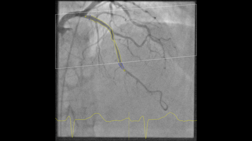 CAAS vFFR - angio-derived FFR measurement - Siemens Healthineers USA