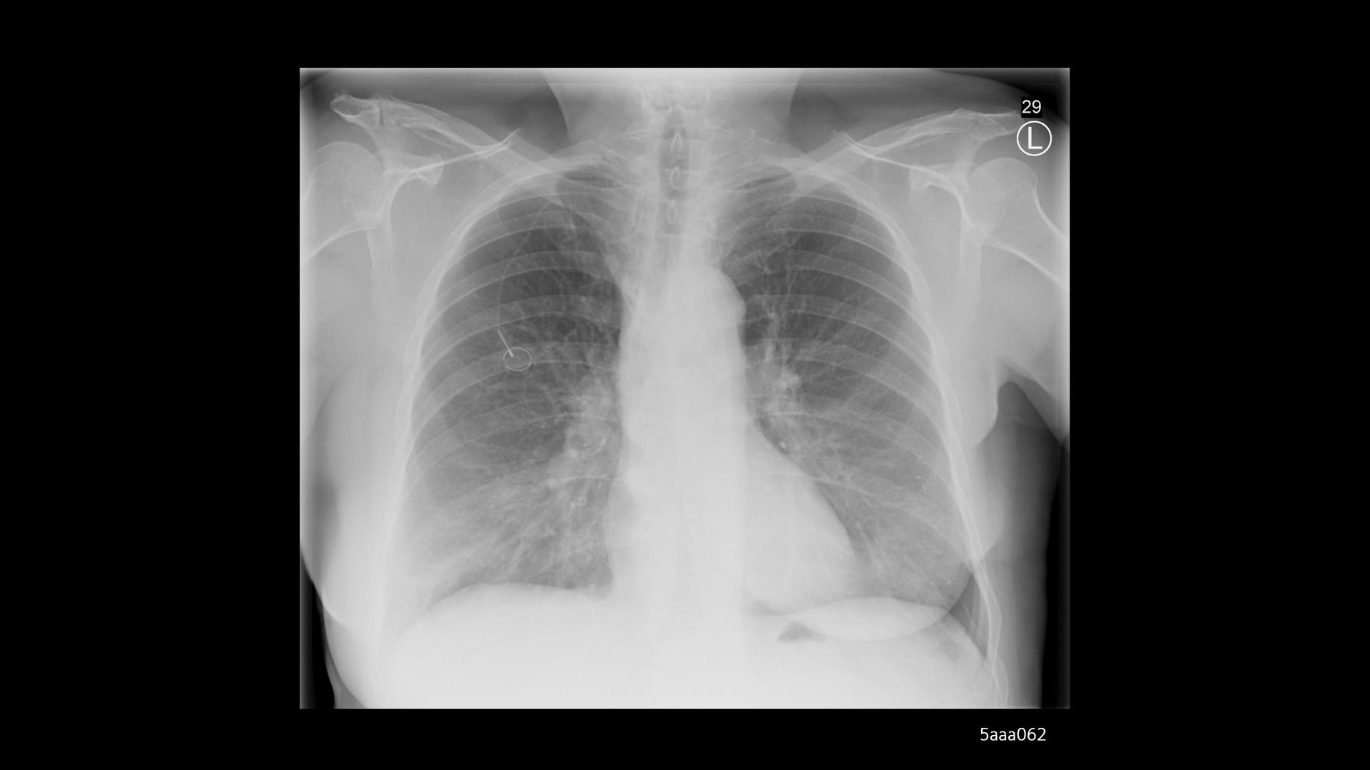 X-ray imaging for COVID-19 patients