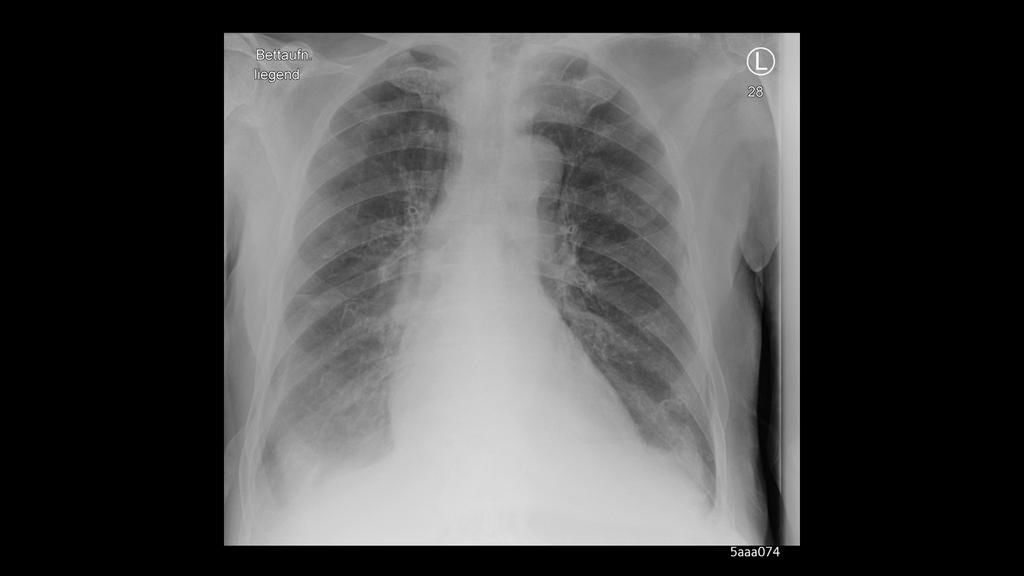 X-ray imaging for COVID-19 patients