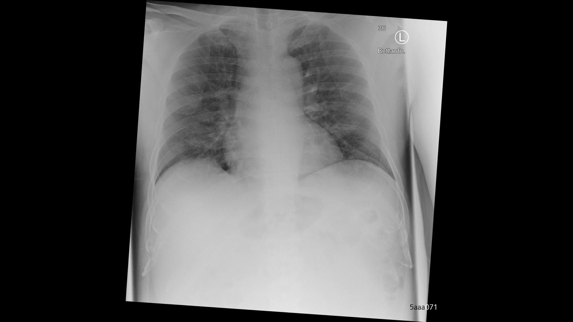 X-ray imaging for COVID-19 patients - Siemens Healthineers Sverige