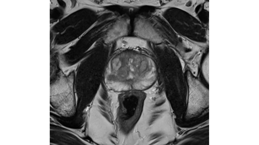 Prostate MRI - Siemens Healthineers