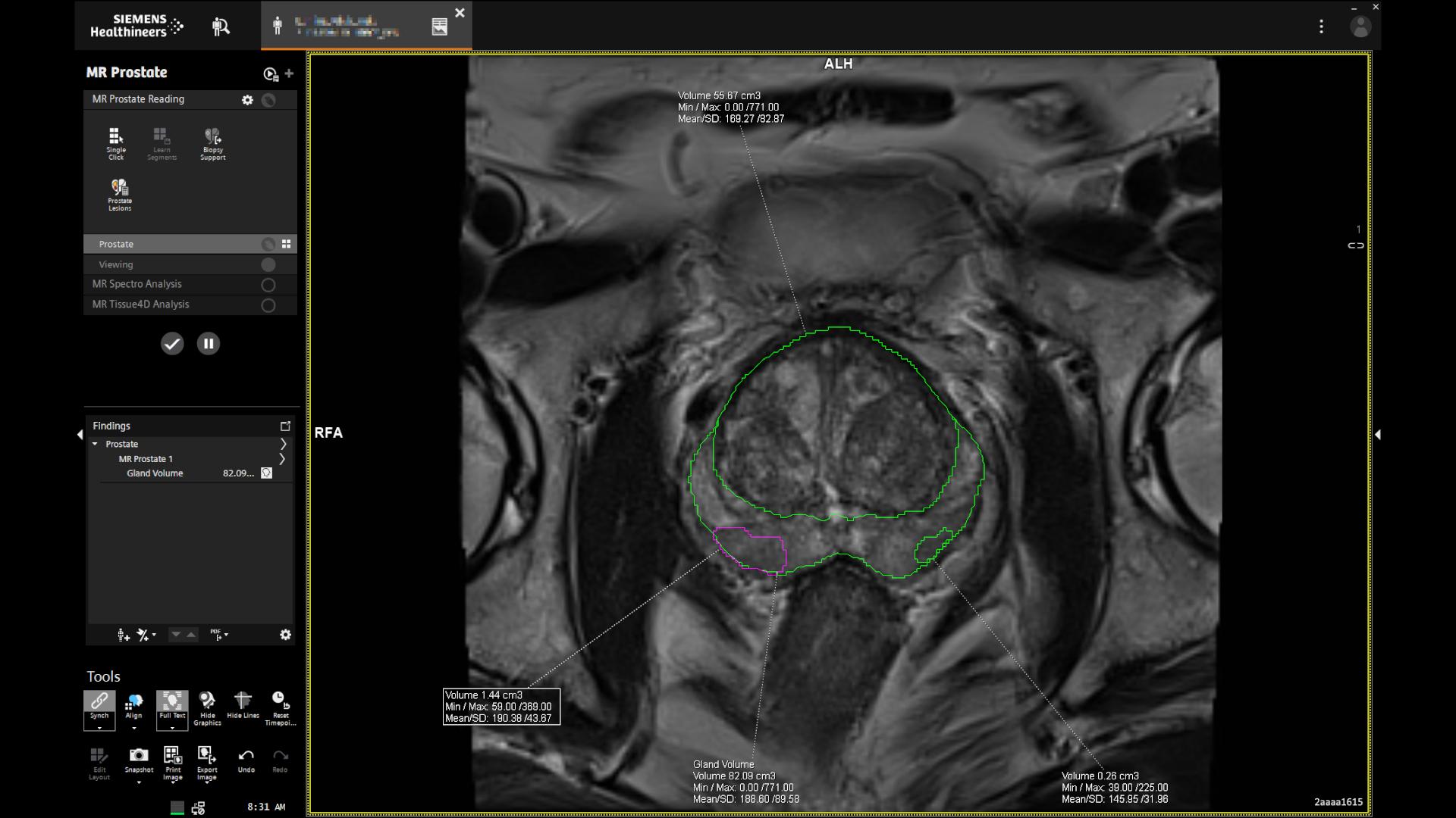 Prostate MRI - Siemens Healthineers