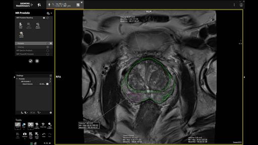 Prostate MRI - Siemens Healthineers