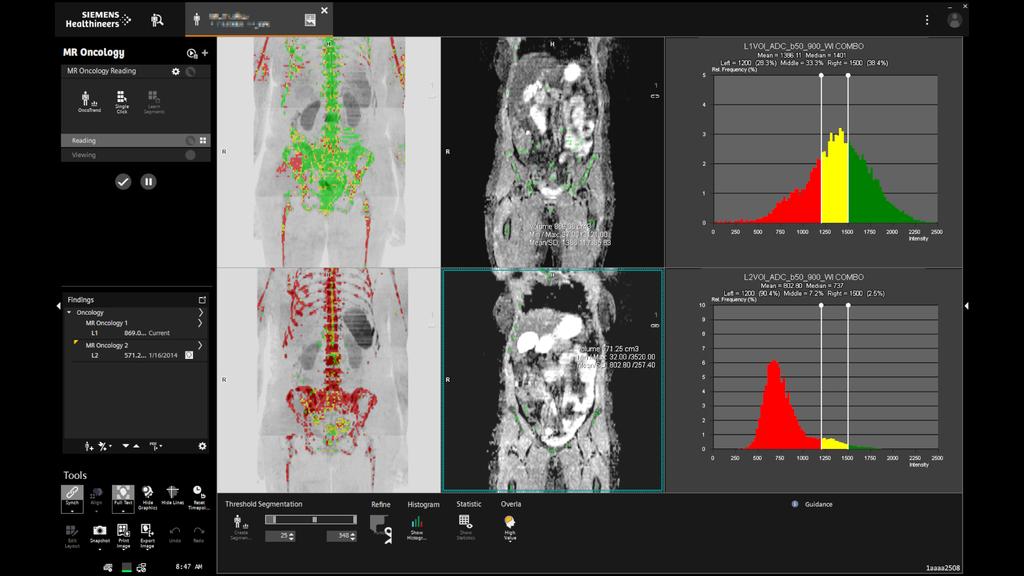 Prostate MRI - Siemens Healthineers