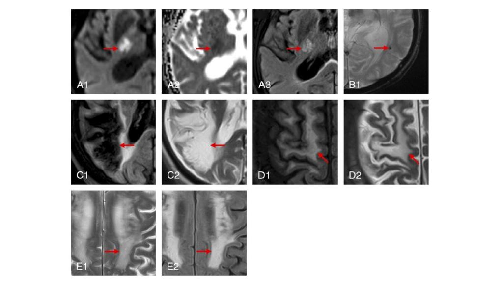 MR Neuro Imaging - MRI Neurology - Siemens Healthineers