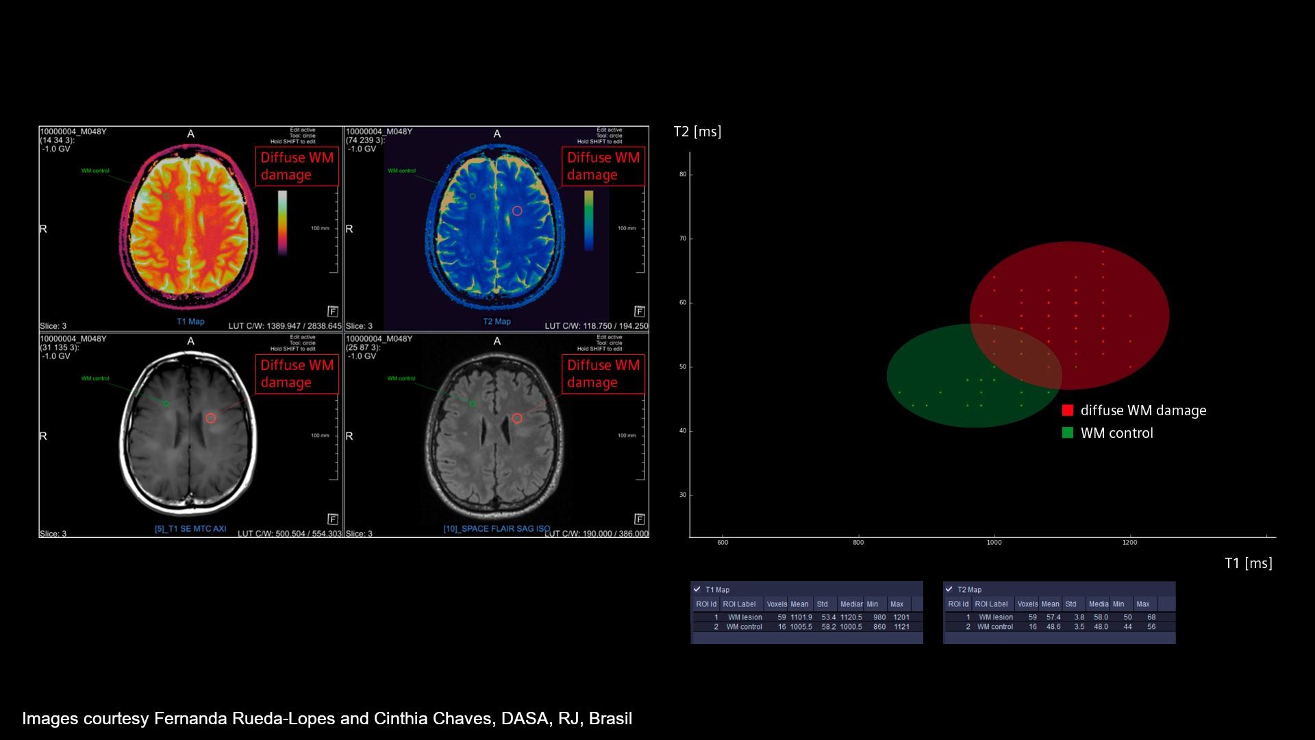 MR Fingerprinting - Siemens Healthineers Bulgaria