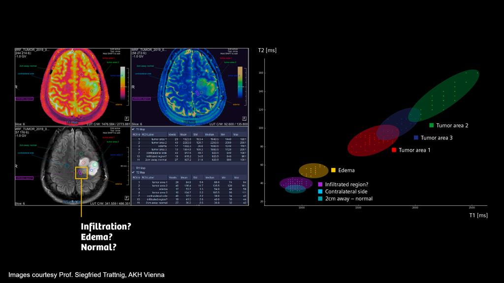 MR Fingerprinting - Siemens Healthineers