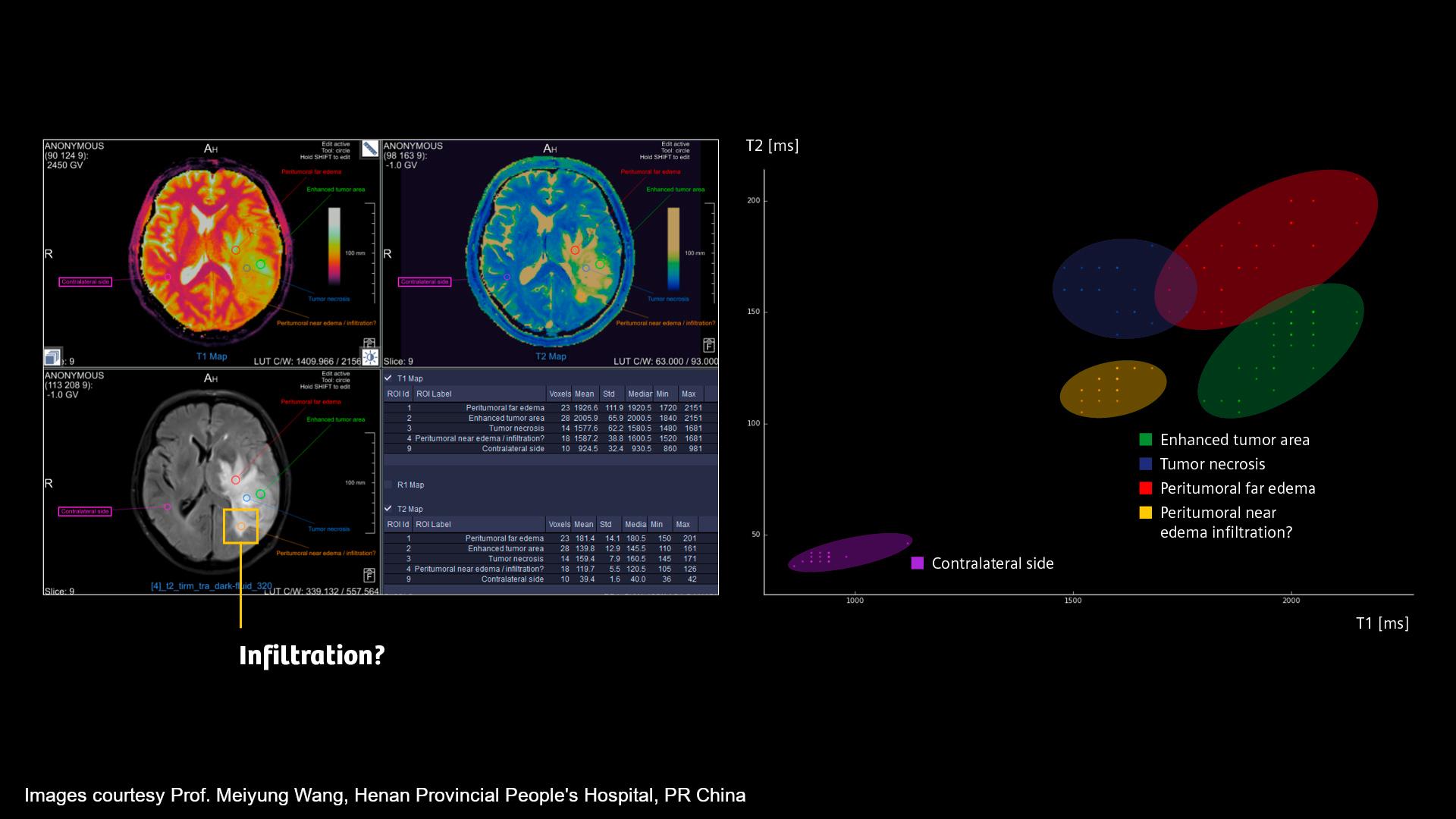 MR Fingerprinting - Siemens Healthineers