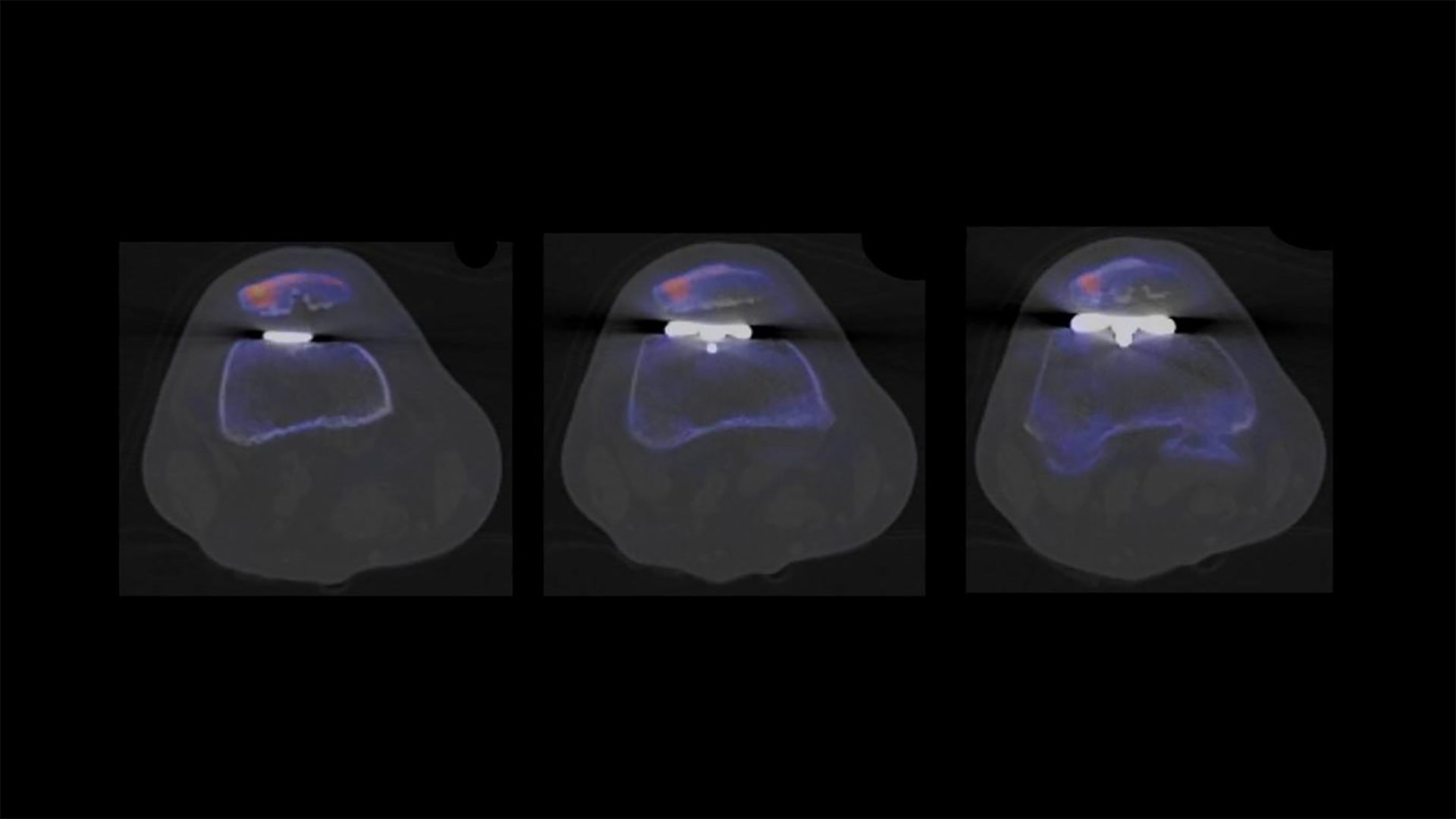 SPECT/CT in evaluation of anterior knee pain following patellofemoral ...