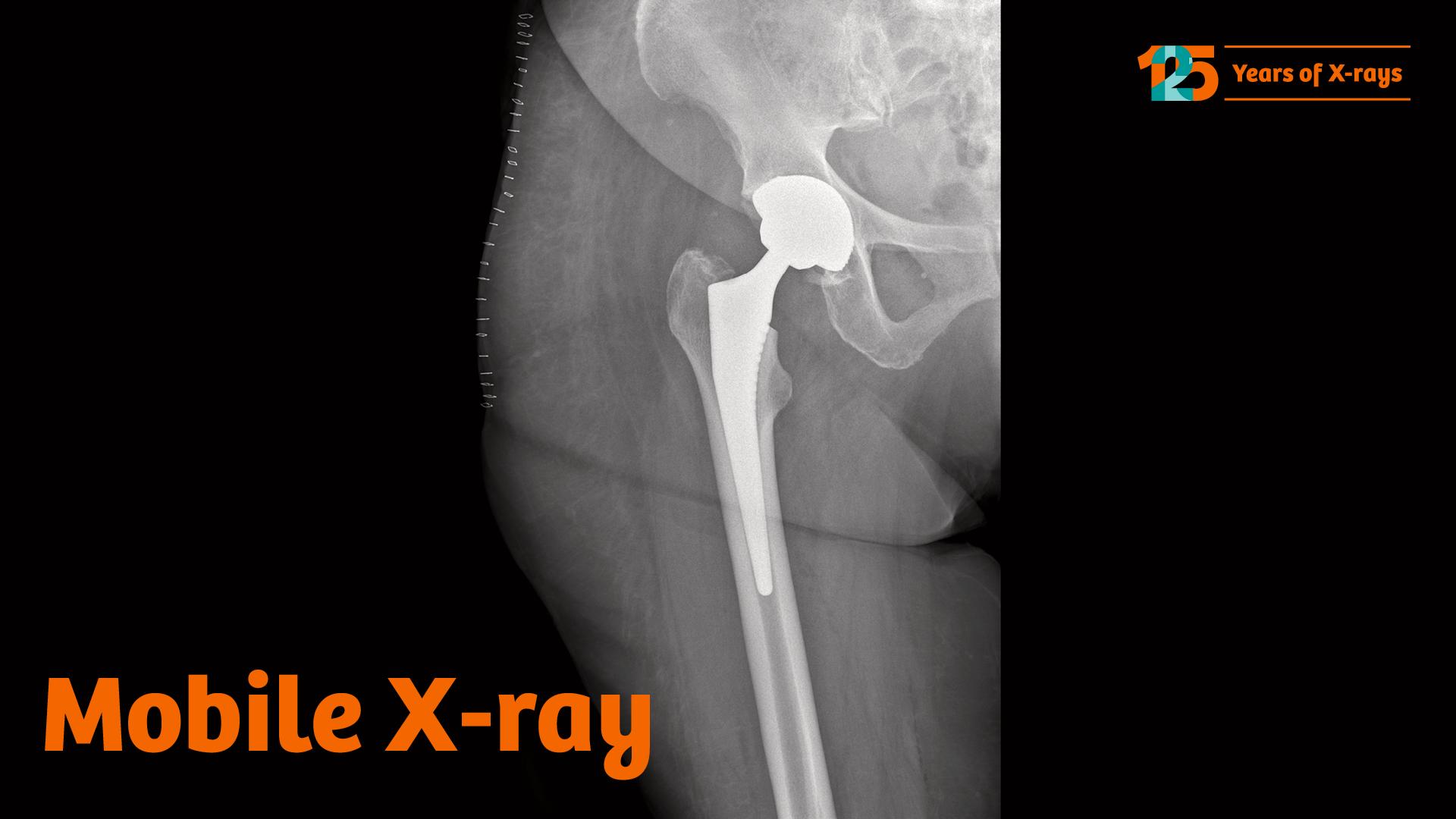 Mobile X-Ray