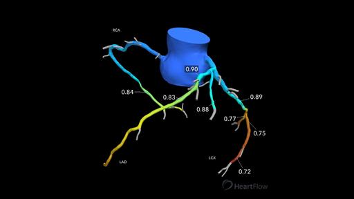 Rethink FFR assessment for every patient - Siemens Healthineers